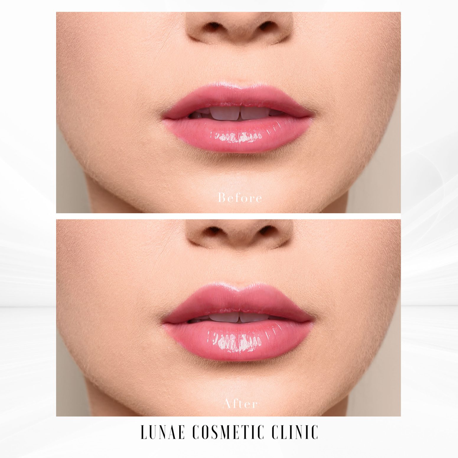 Can lip filler look unnatural or ‘fake’? - Lunae Cosmetic Clinic